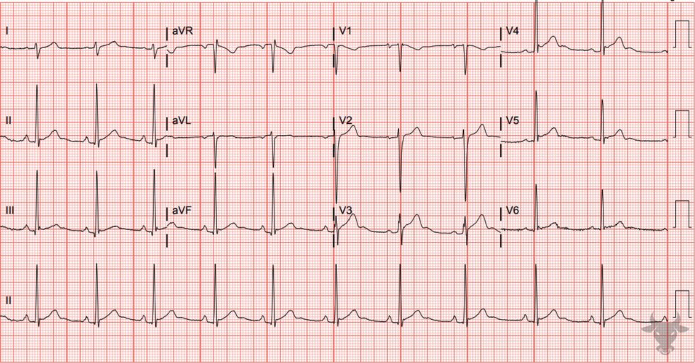 Early Repolarization | ECG Stampede