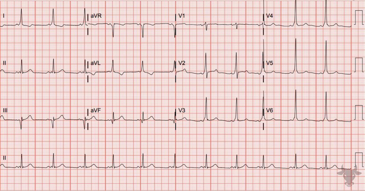 Ventricular Pre-excitation | ECG Stampede