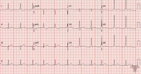 Ventricular Pre-excitation | ECG Stampede