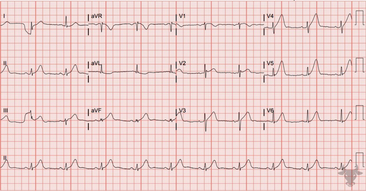 ST-elevation Myocardial Infarction | ECG Stampede