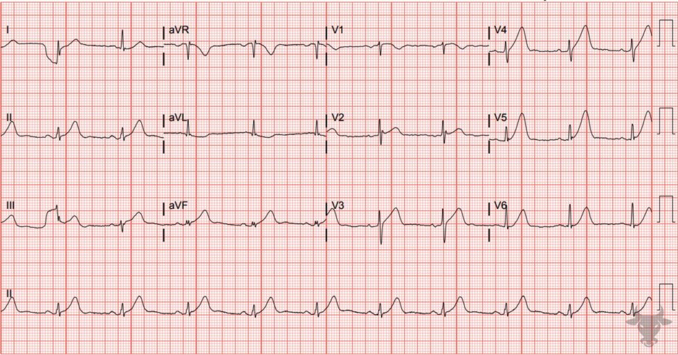 ST-elevation Myocardial Infarction | ECG Stampede