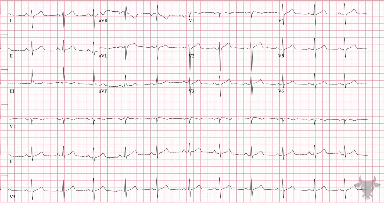 Left Posterior Fascicular Block | ECG Stampede