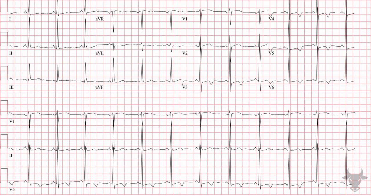 T-wave Inversions | ECG Stampede