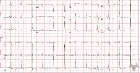 T-wave Inversions | ECG Stampede