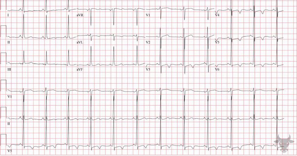 T-wave Inversions | ECG Stampede
