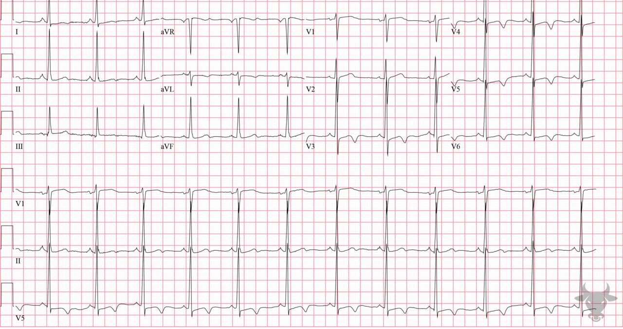 Hypertrophic Cardiomyopathy | ECG Stampede