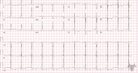 Hypertrophic Cardiomyopathy | ECG Stampede