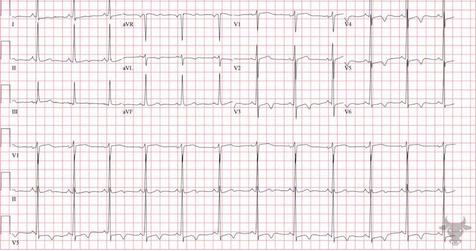 Hypertrophic Cardiomyopathy | ECG Stampede