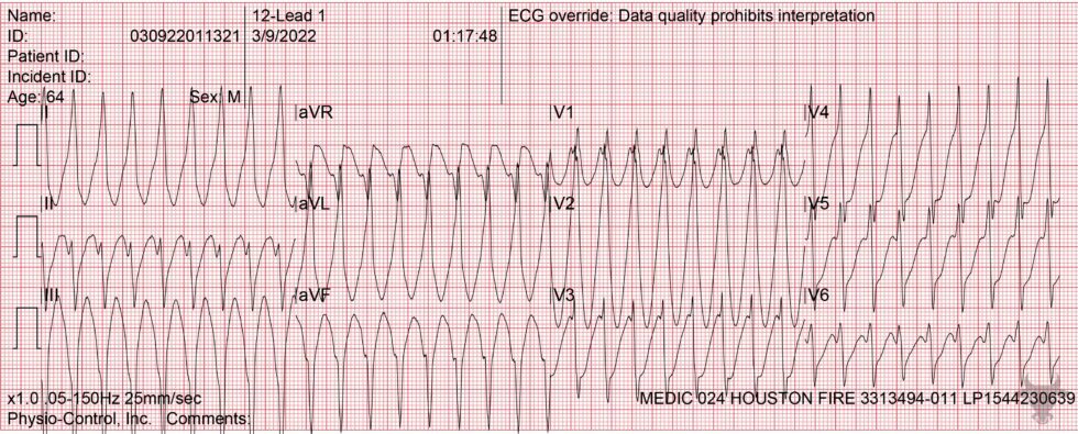 Ventricular Tachycardia | ECG Stampede