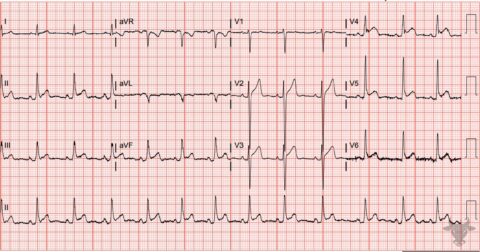 Acute Pericarditis | ECG Stampede