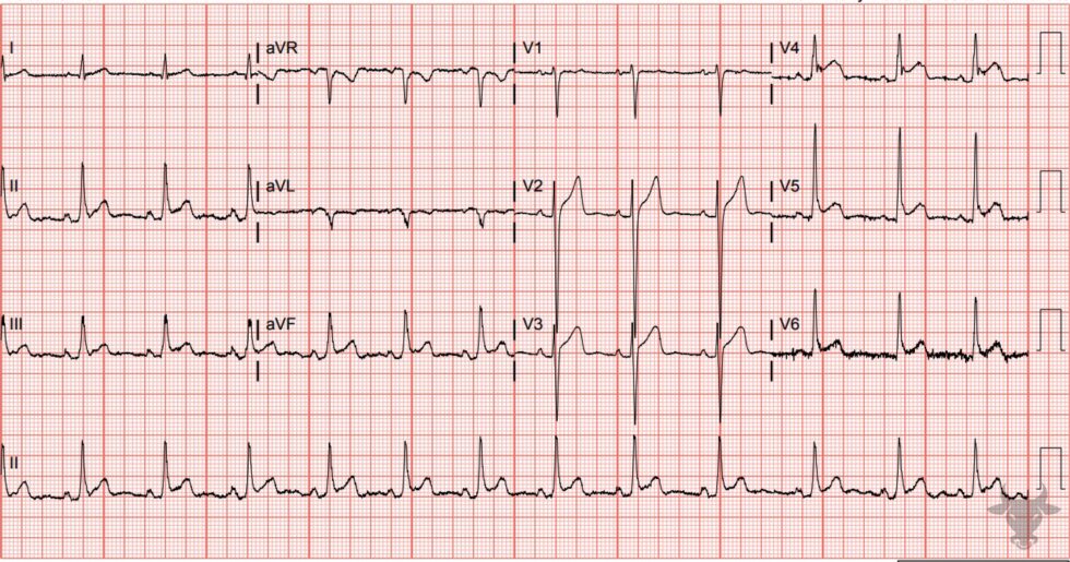 Acute Pericarditis | ECG Stampede