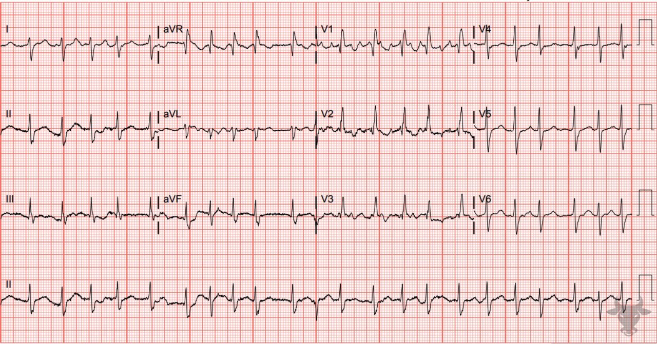 Bifascicular Block | ECG Stampede