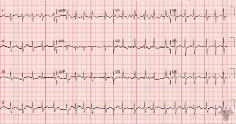 Bifascicular Block | ECG Stampede