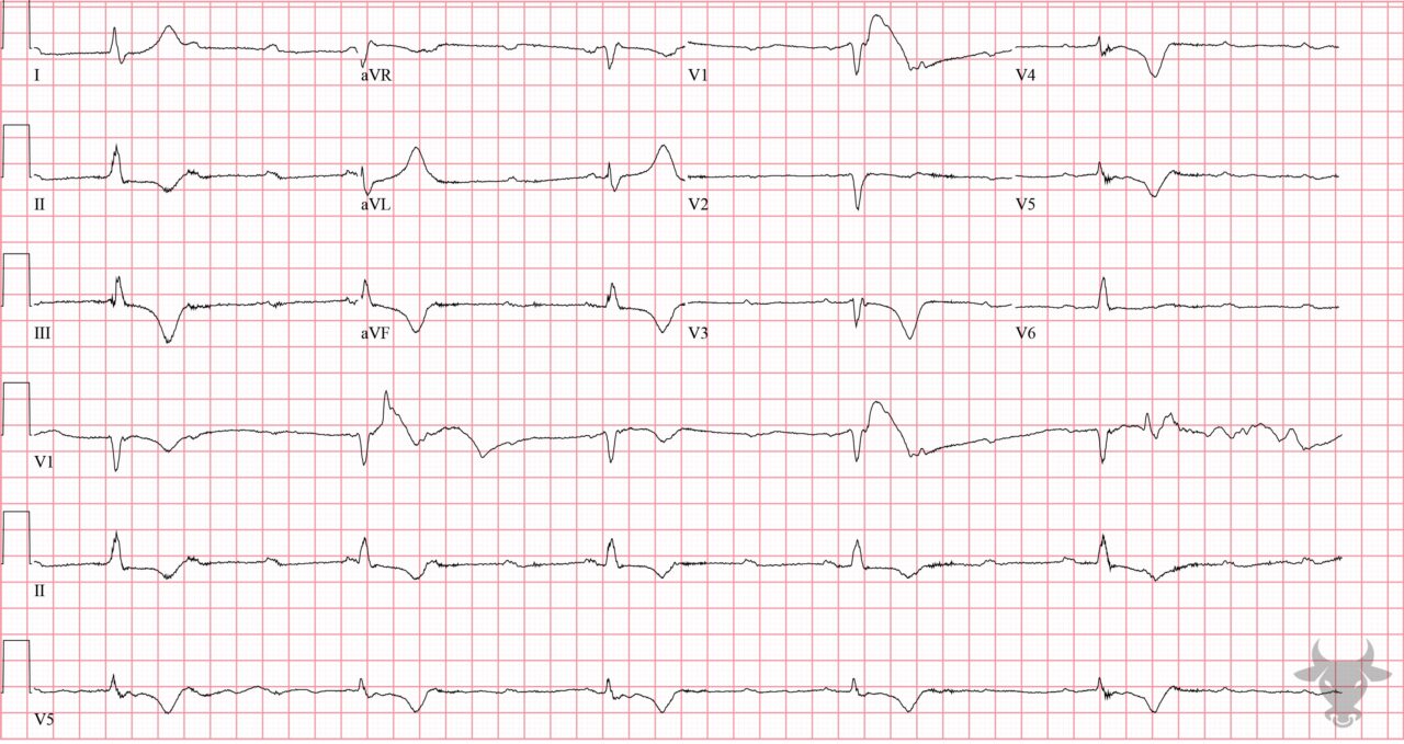 Third Degree Atrioventricular Block | ECG Stampede