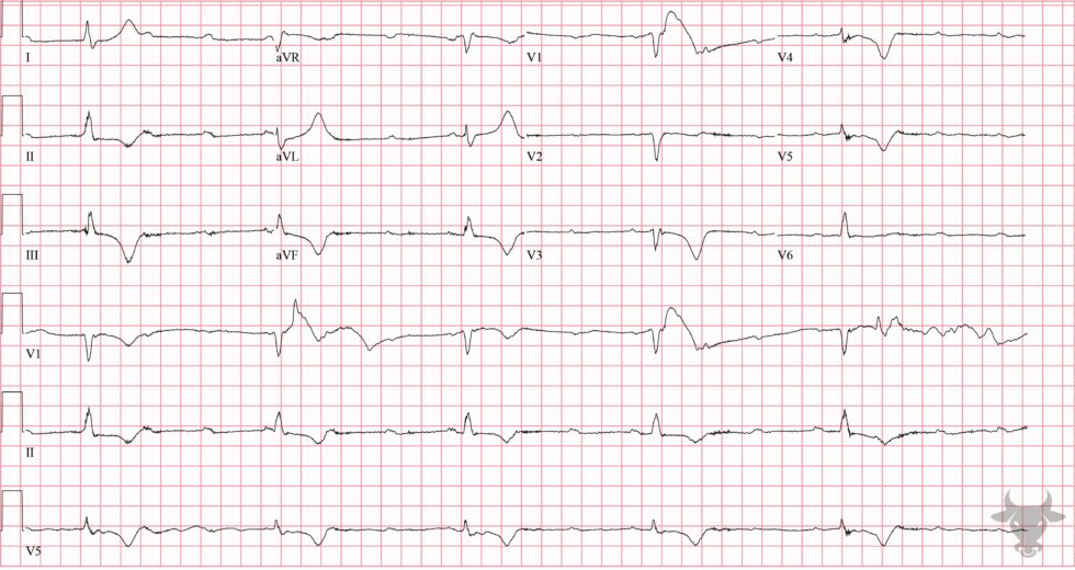 Third Degree Atrioventricular Block | ECG Stampede