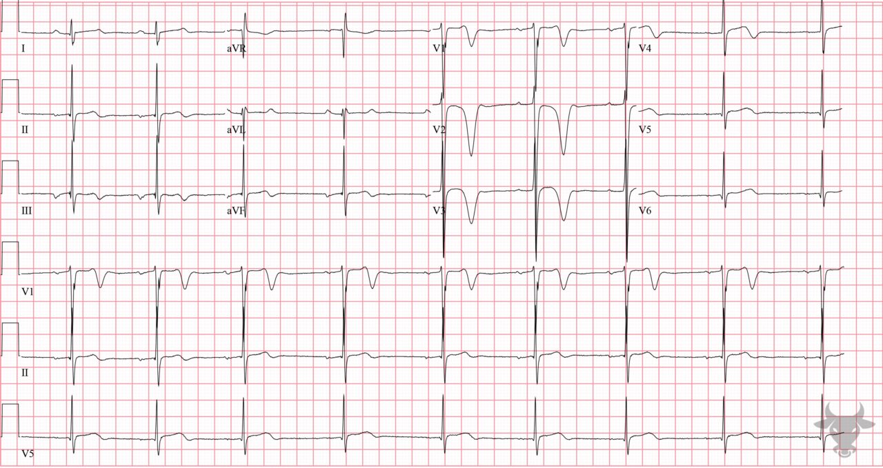 Hypertrophic Cardiomyopathy | ECG Stampede