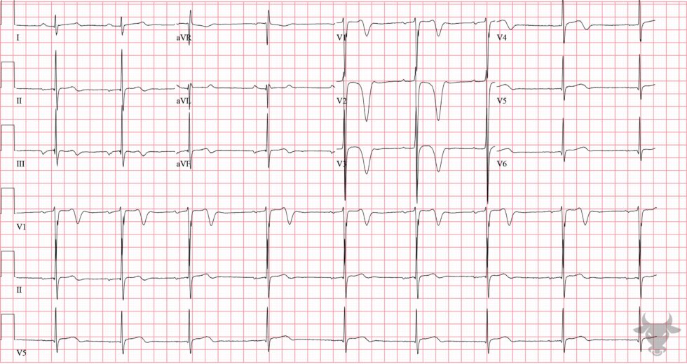 Hypertrophic Cardiomyopathy | ECG Stampede