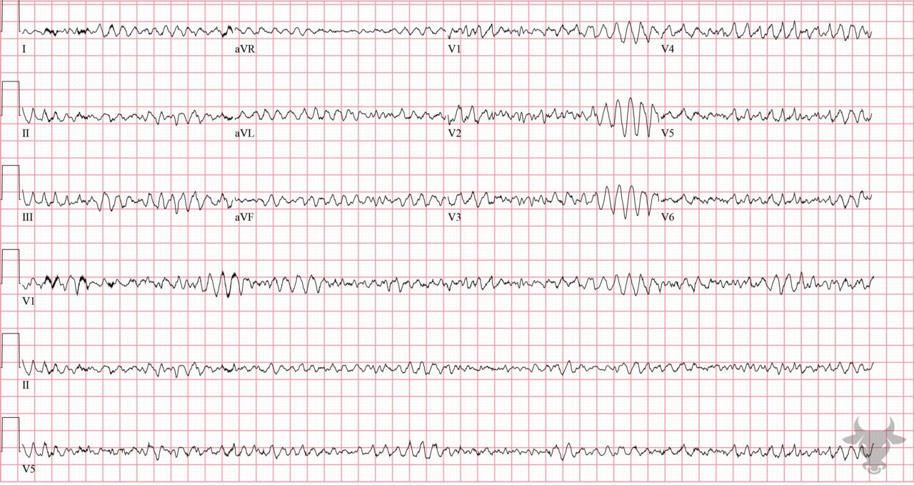 Ventricular Fibrillation | ECG Stampede