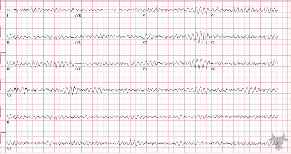 Ventricular Fibrillation | ECG Stampede