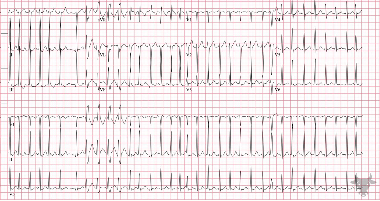 Ashman Phenomenon | ECG Stampede