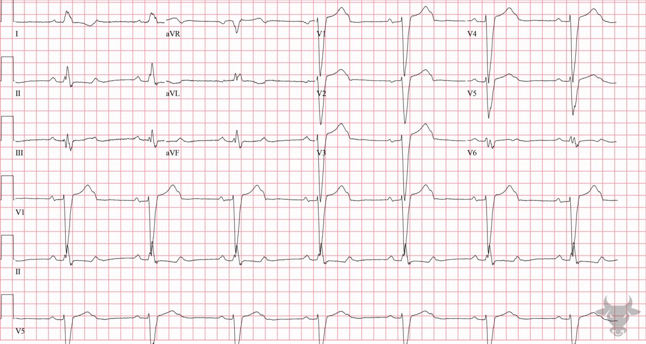 Second Degree Atrioventricular Block 2:1 | ECG Stampede