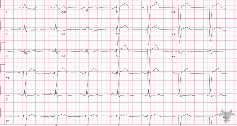 Second Degree Atrioventricular Block 2:1 | ECG Stampede