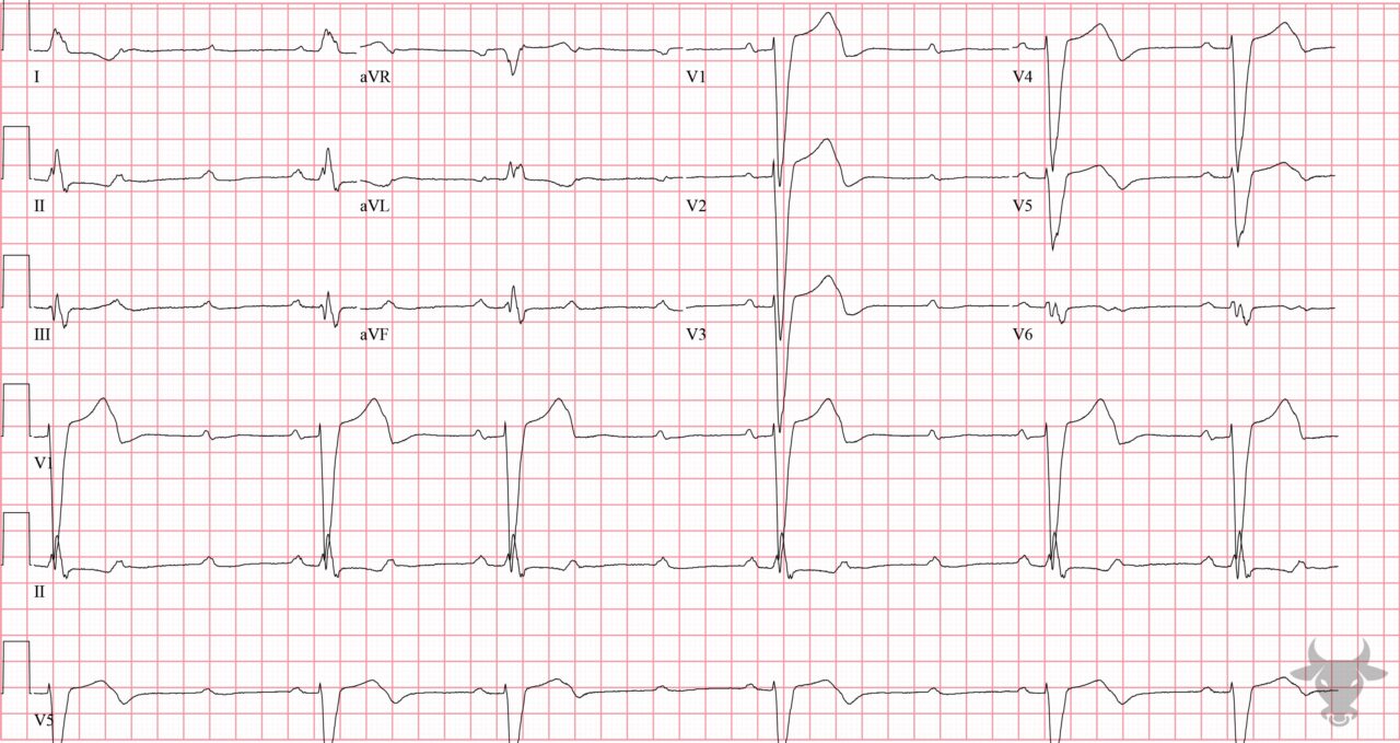 Second Degree Atrioventricular Block – Mobitz II | ECG Stampede