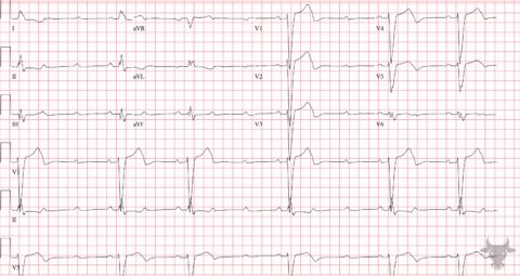 Second Degree Atrioventricular Block – Mobitz II | ECG Stampede