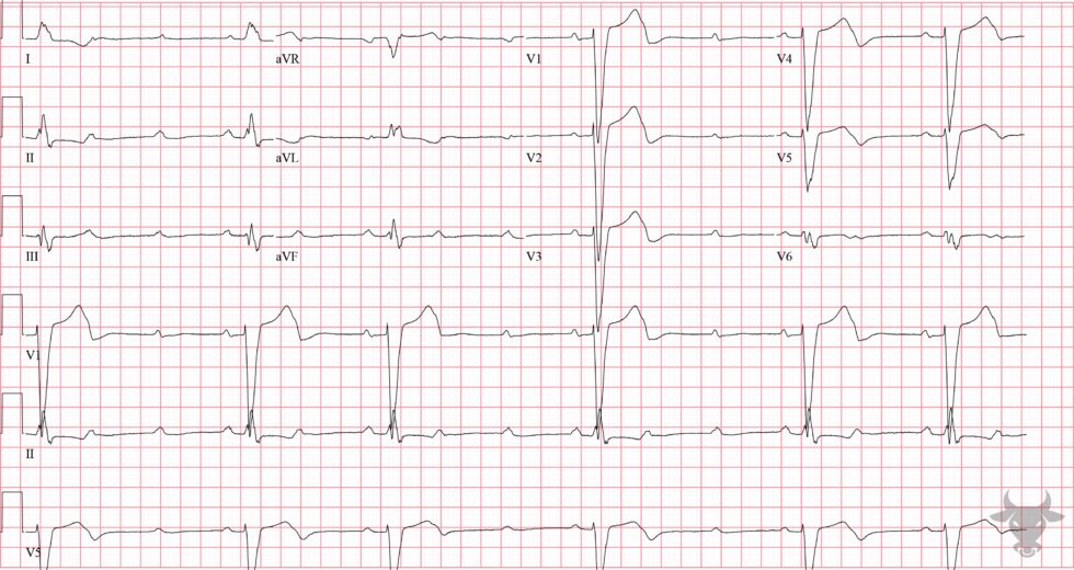 Second Degree Atrioventricular Block – Mobitz II | ECG Stampede