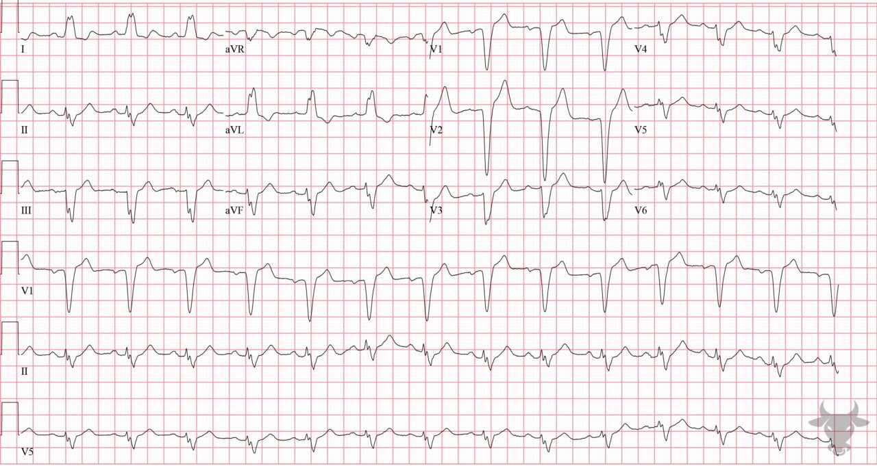Left Bundle Branch Block | ECG Stampede
