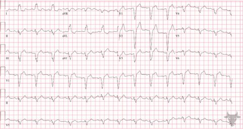 Left Bundle Branch Block | ECG Stampede
