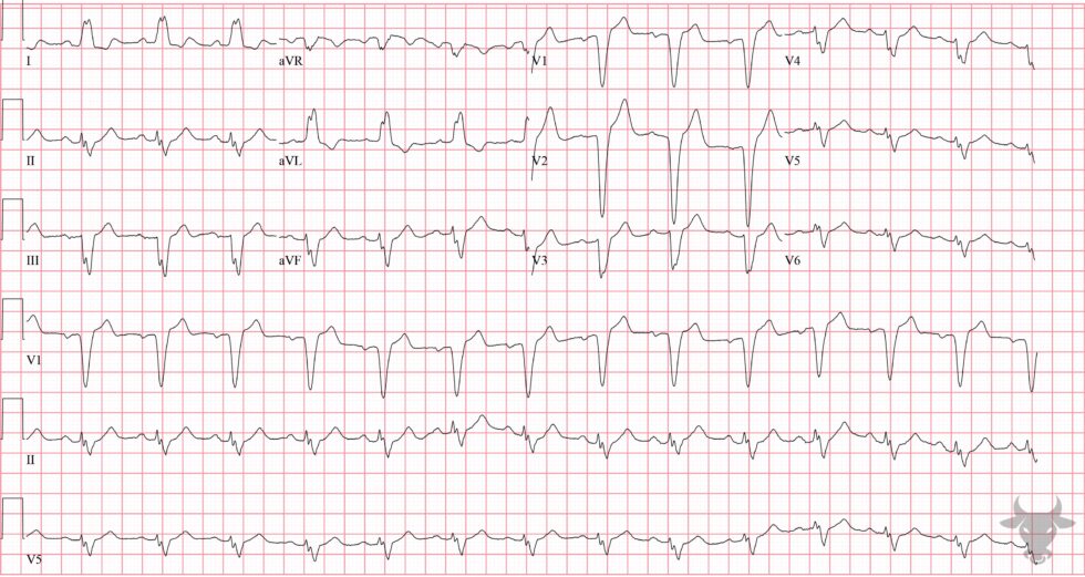 Left Bundle Branch Block | ECG Stampede