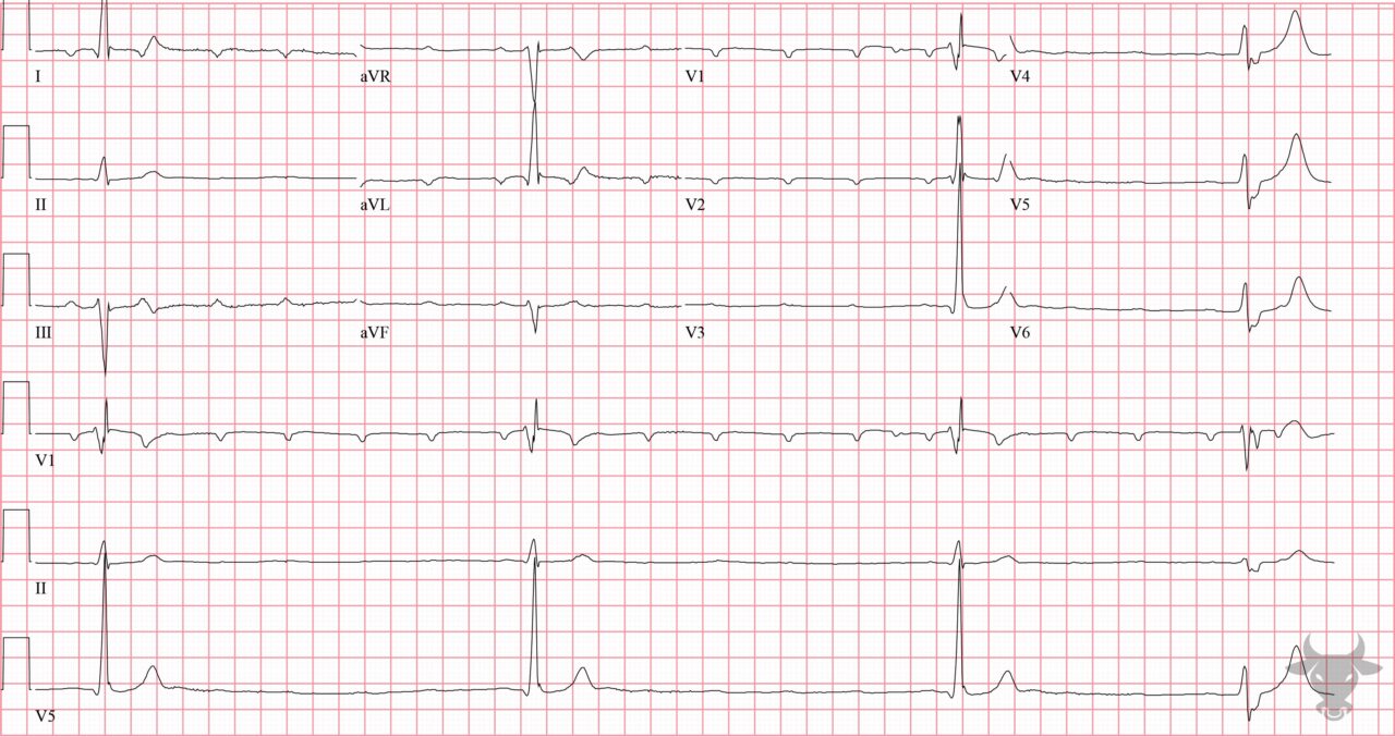 Third Degree Atrioventricular Block | ECG Stampede