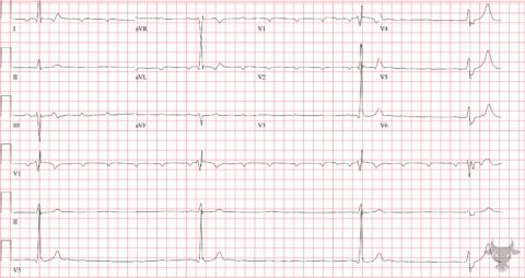 Third Degree Atrioventricular Block | ECG Stampede