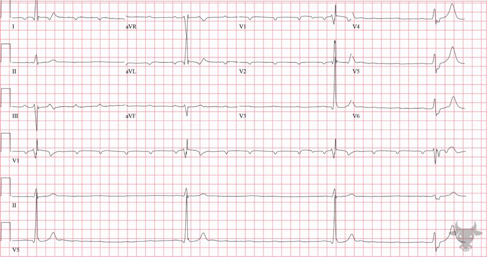 Third Degree Atrioventricular Block | ECG Stampede