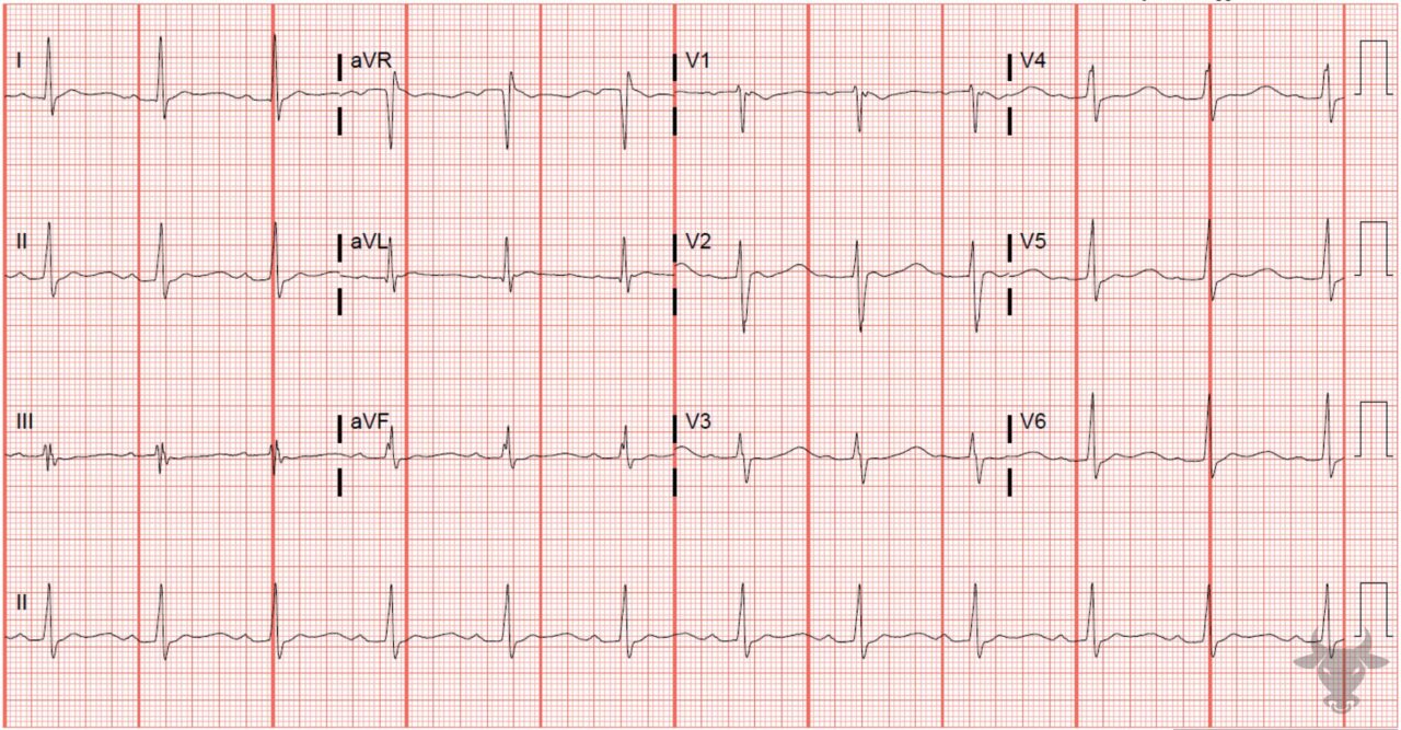 Prolonged QT | ECG Stampede