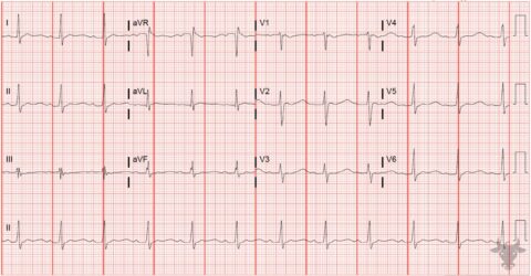 Hypokalemia | ECG Stampede