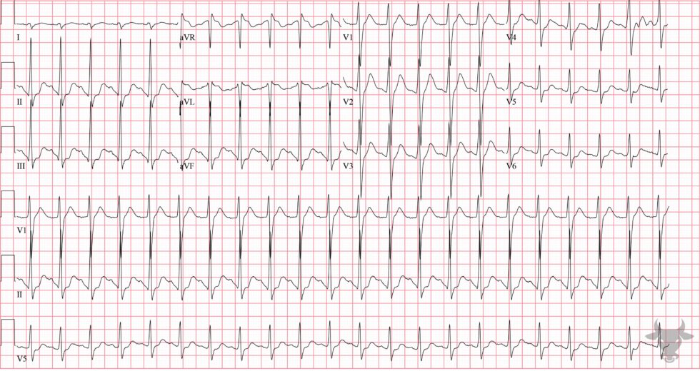 Sodium Channel Toxicity | ECG Stampede