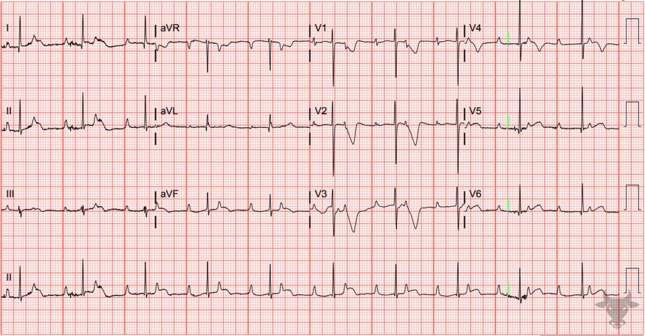 Third Degree Atrioventricular Block | ECG Stampede