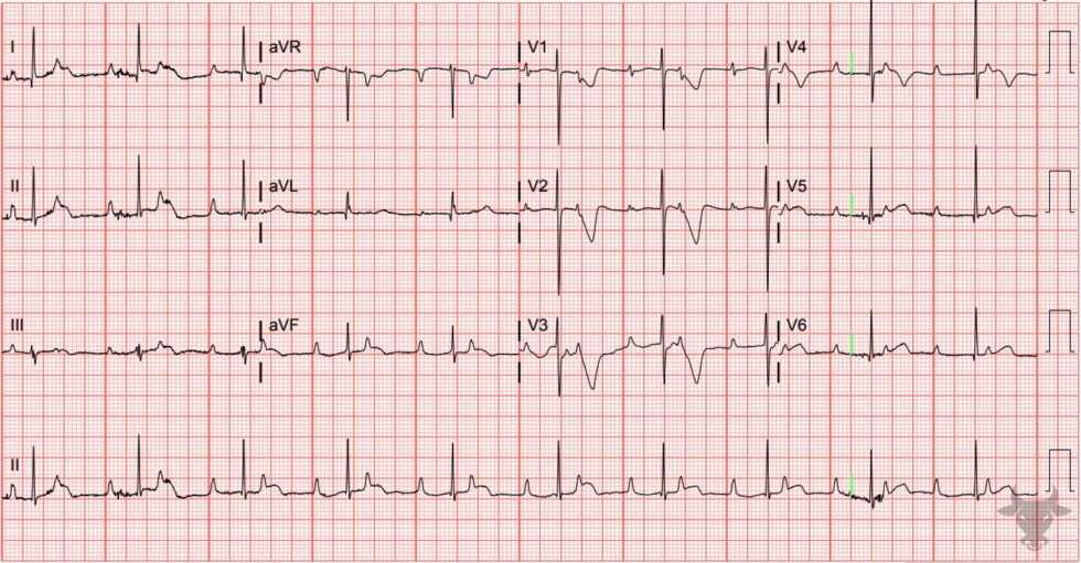Third Degree Atrioventricular Block | ECG Stampede
