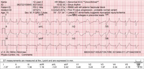 Hyperkalemia | ECG Stampede