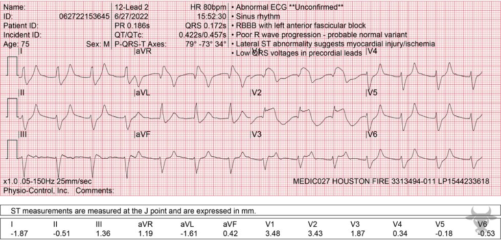 Hyperkalemia | ECG Stampede