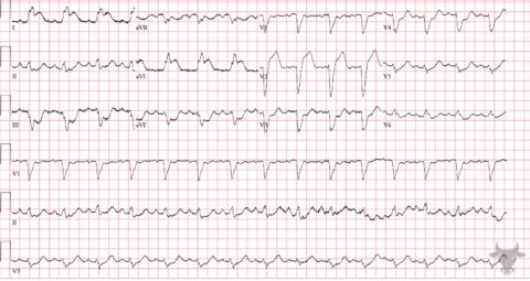 Sgarbossa Criteria | ECG Stampede