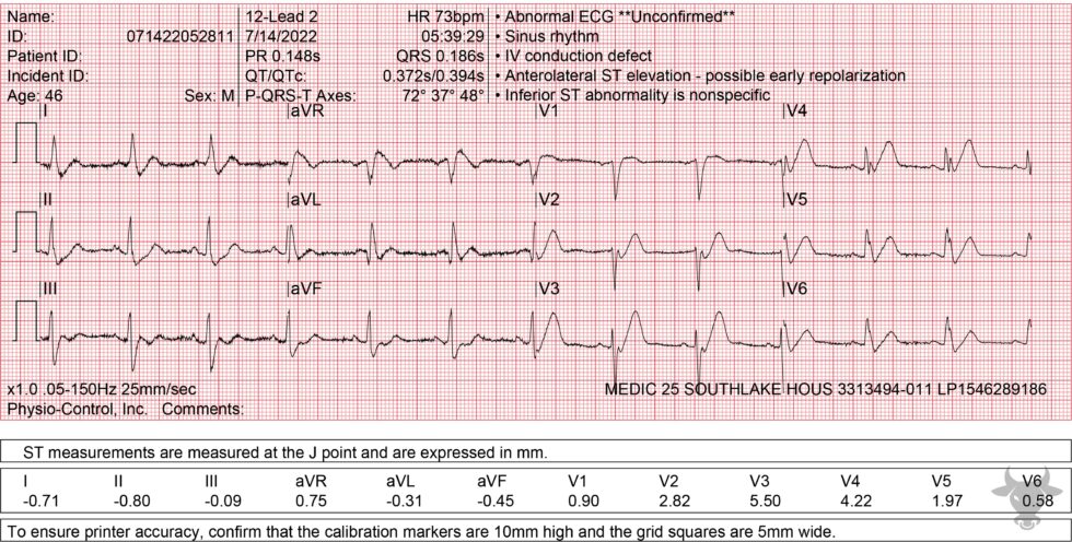 ST-elevation Myocardial Infarction | ECG Stampede