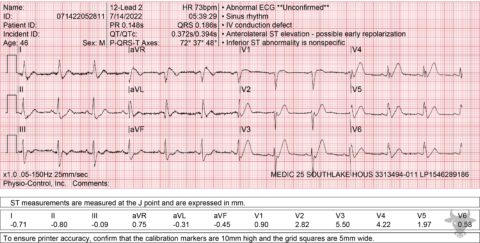 Hyperacute T Waves | ECG Stampede