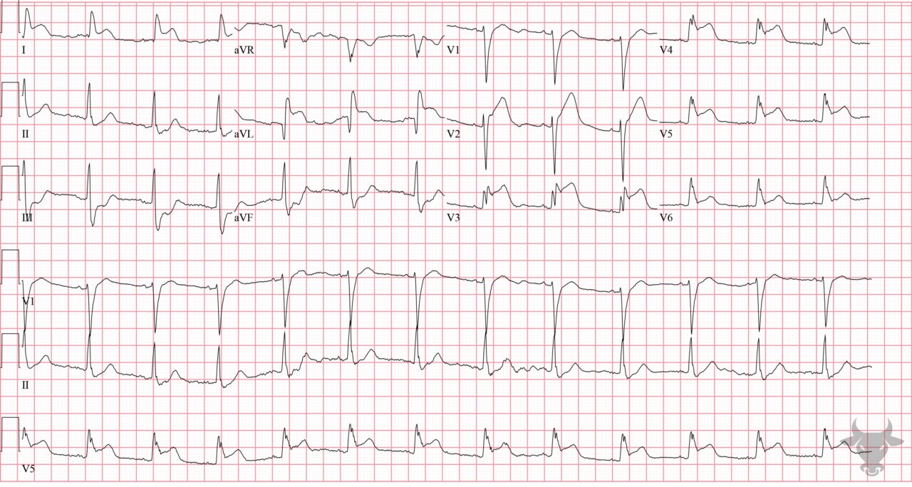 ST-elevation Myocardial Infarction | ECG Stampede