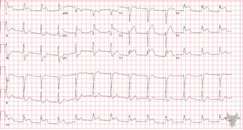 ST-elevation Myocardial Infarction | ECG Stampede