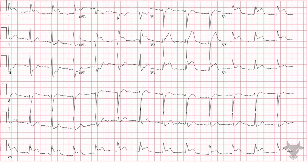 ST-elevation Myocardial Infarction | ECG Stampede