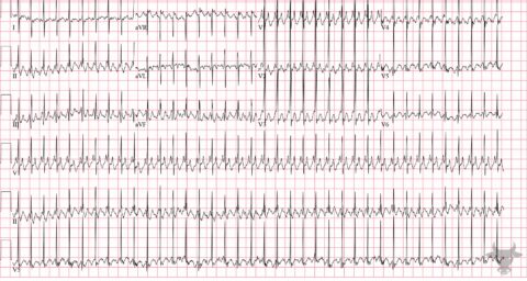 Atrial Flutter | ECG Stampede