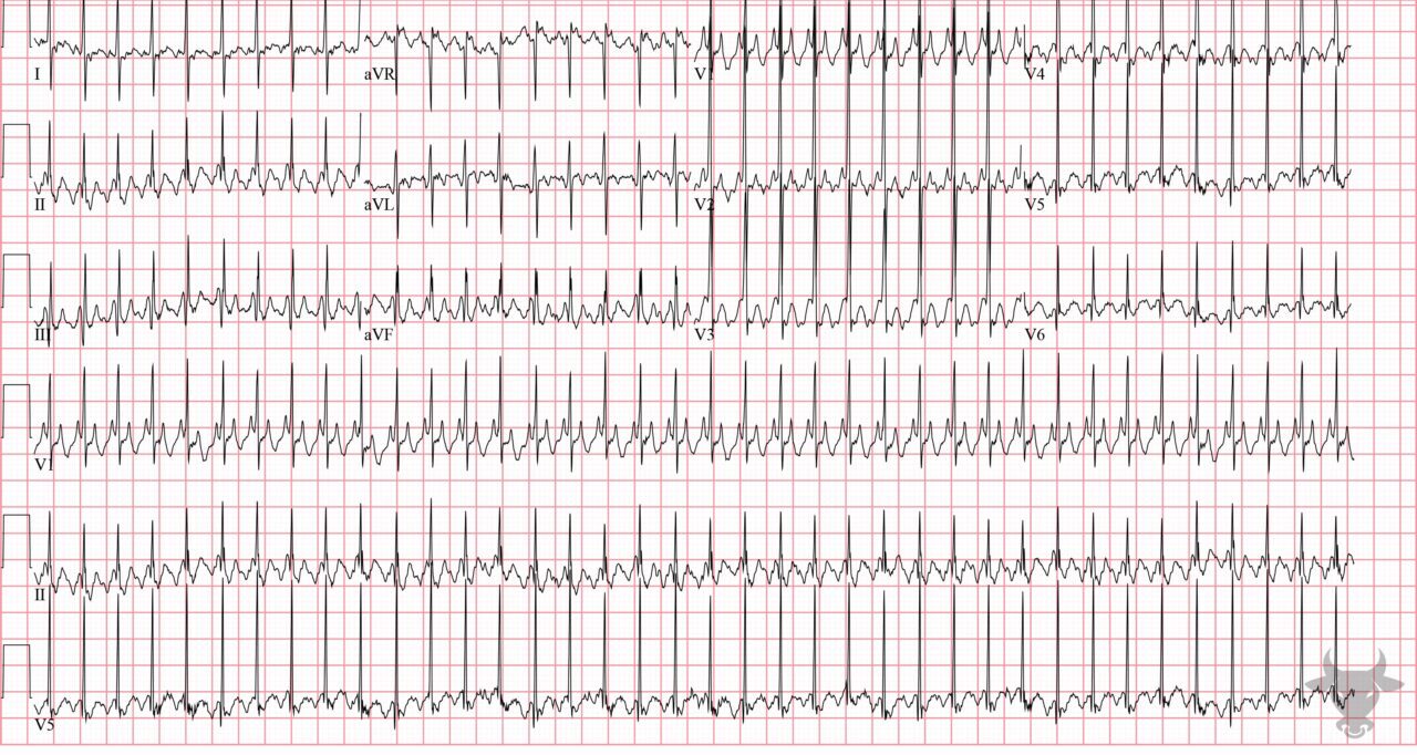Supraventricular Tachycardia | ECG Stampede